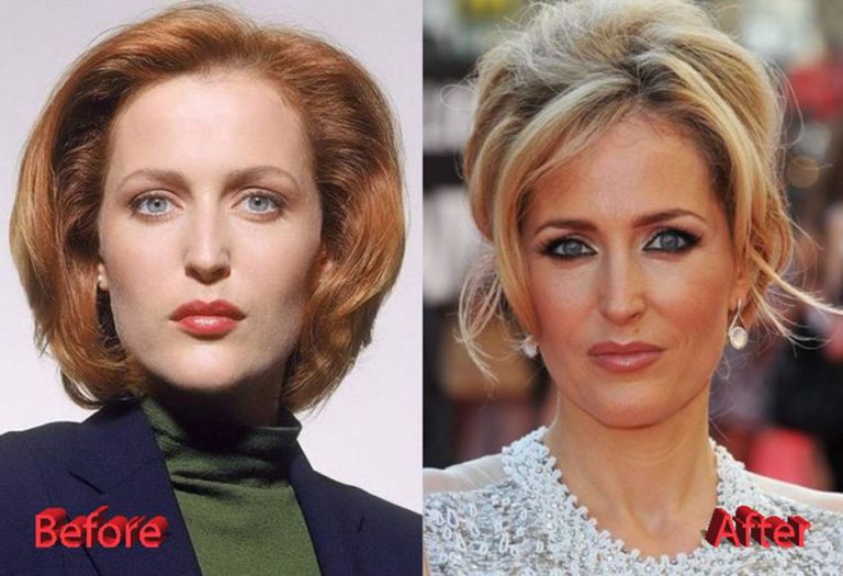 The Right Kind of Changes from Gillian Anderson’s Plastic Surgery | Go ...